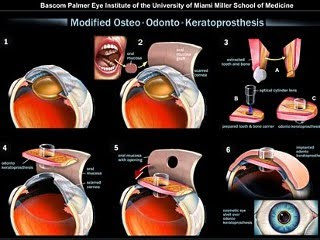 Creating Beautiful Smiles One at a Time: Sight restored by her TOOTH?!